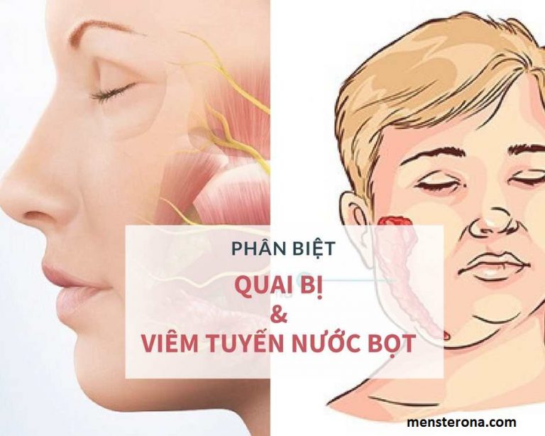 Phân biệt bệnh quai bị và viêm tuyến nước bọt mang tai | Mensterona
